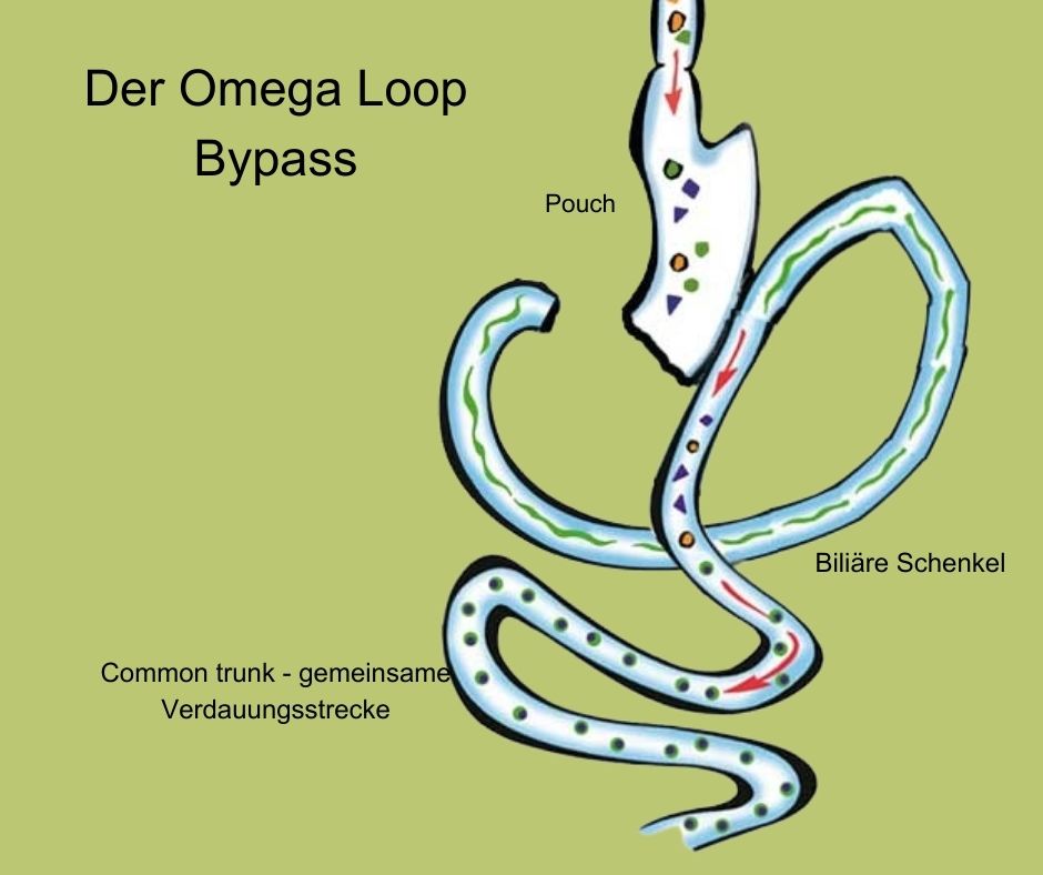 Operationen - Klinik für MIC Zentrum für Adipositas und metabolische ...